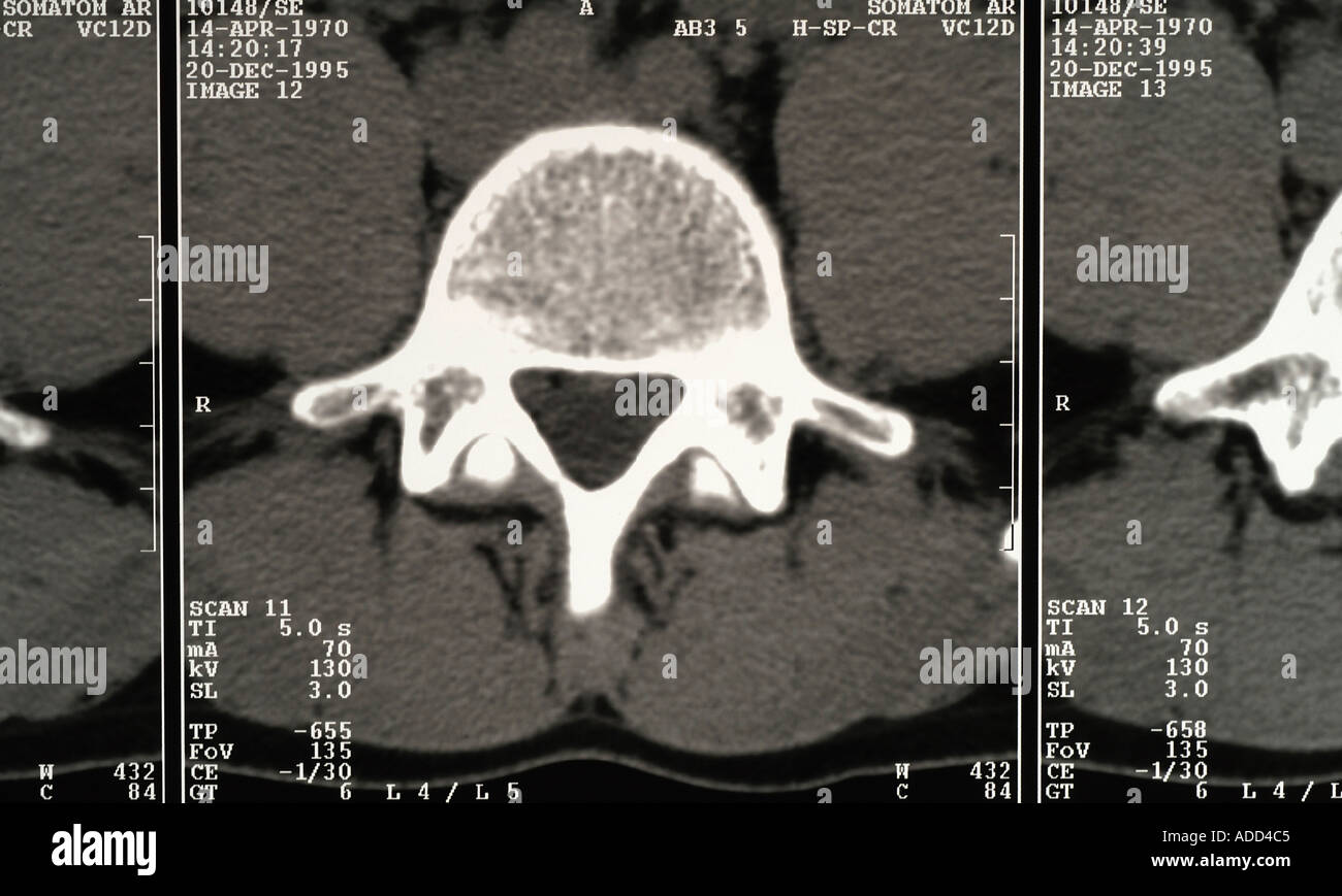scan of human spinal column Stock Photo - Alamy