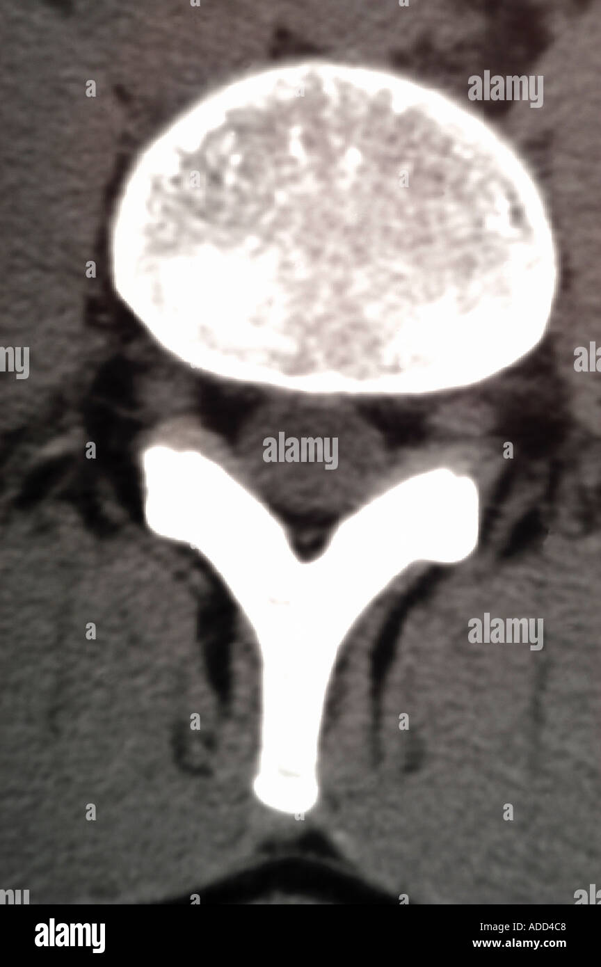 scan of human spinal column Stock Photo - Alamy