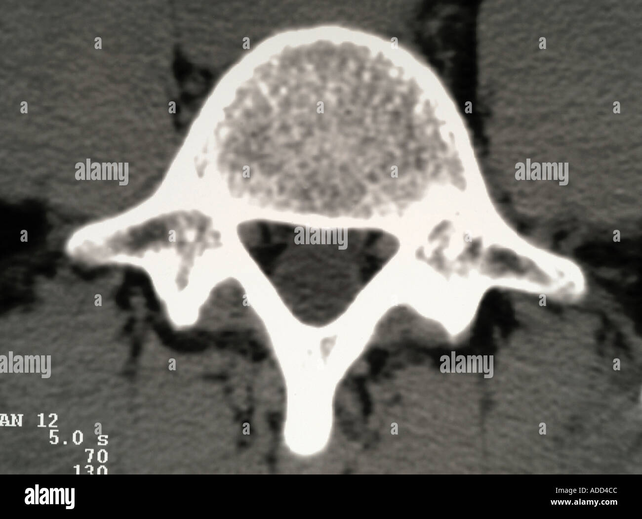 scan of human spinal column Stock Photo - Alamy