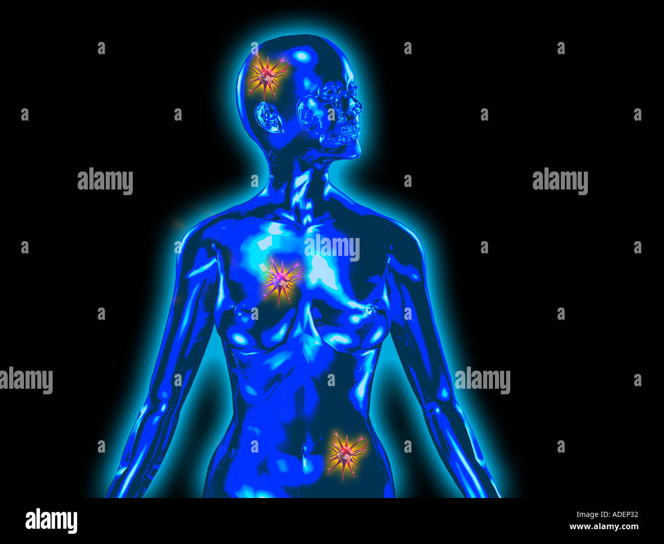 cancer or tumors on a female body concept Stock Photo - Alamy