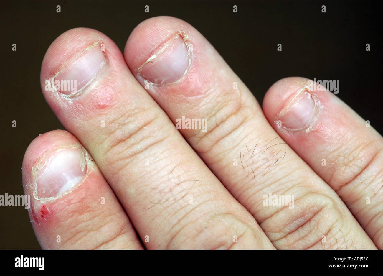 Close up of bitten fingernails Stock Photo - Alamy