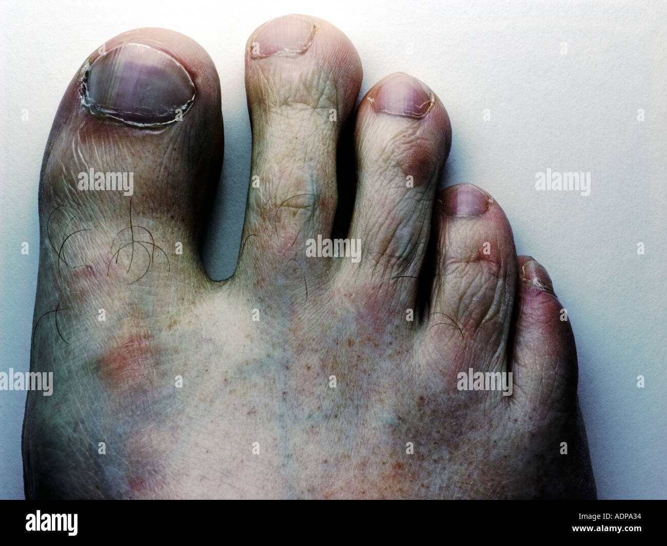 Bruised toe nails hi-res stock photography and images - Alamy