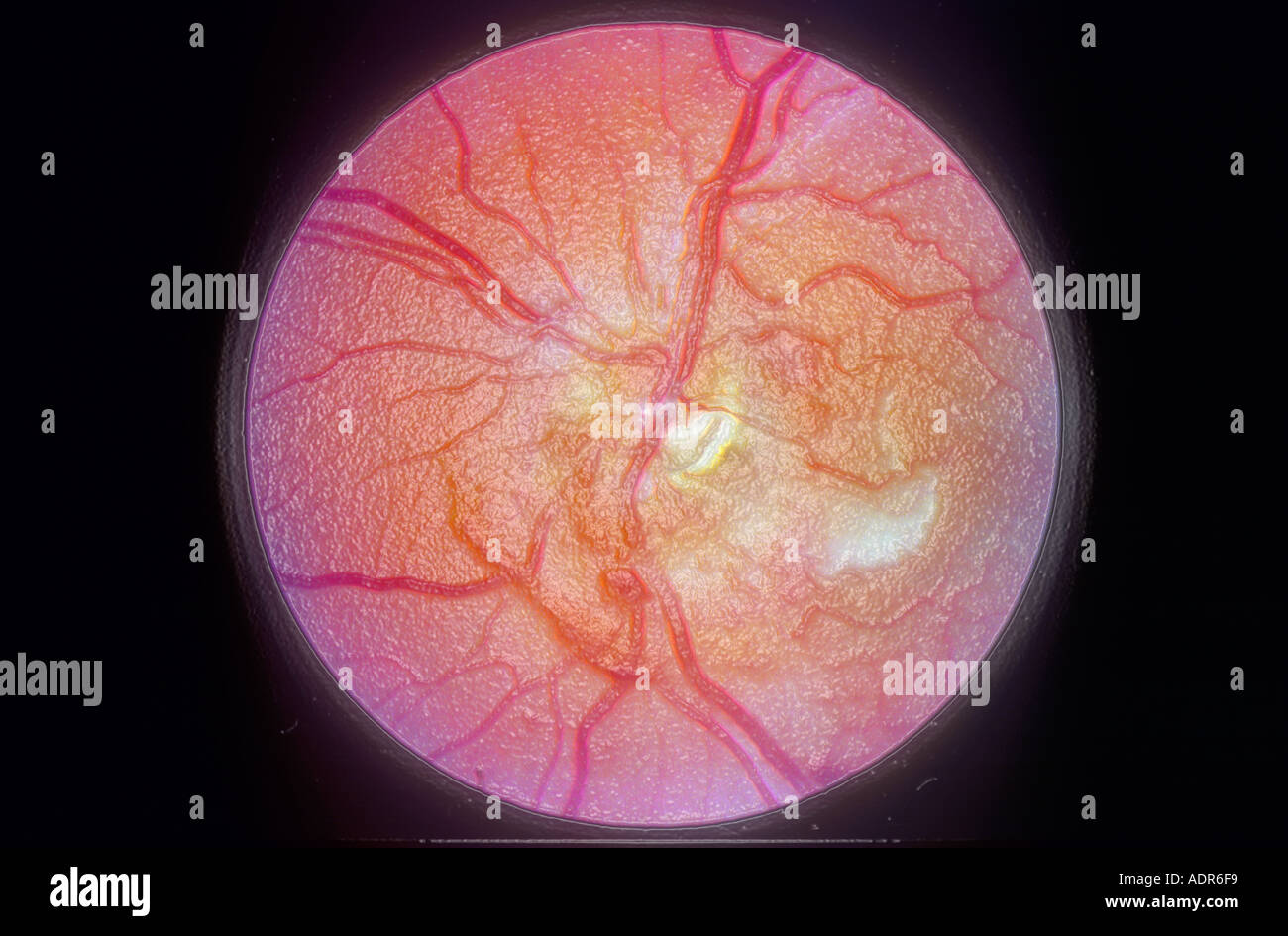 Optic disc hi-res stock photography and images - Alamy