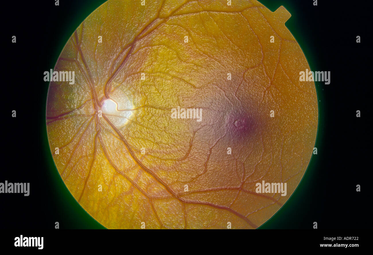 Normal retina hi-res stock photography and images - Alamy