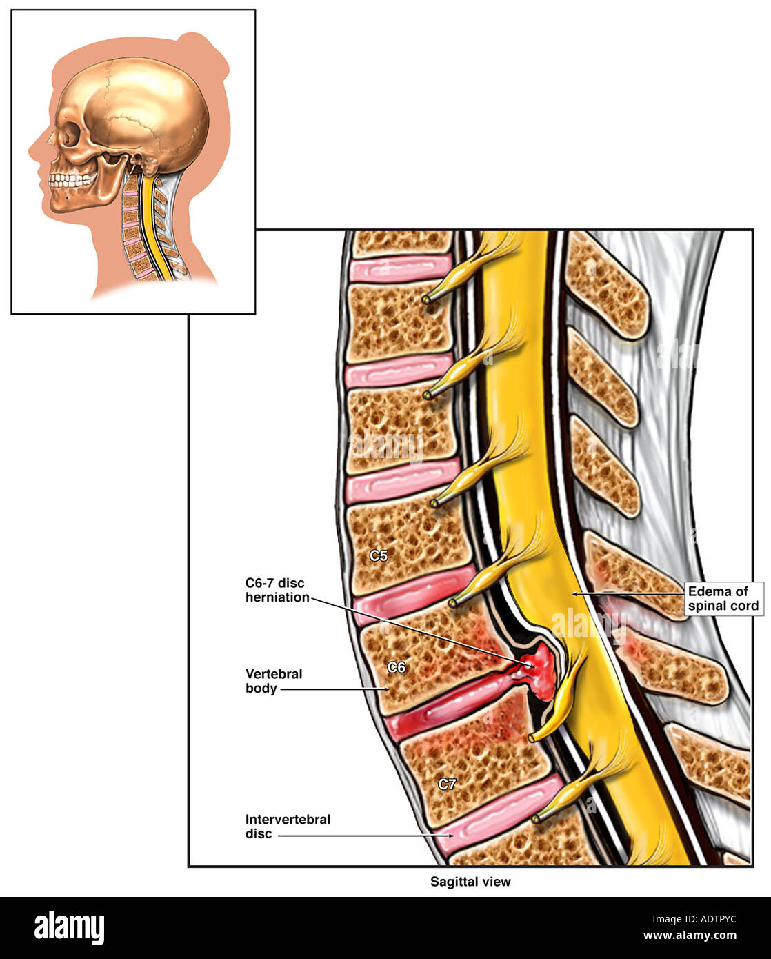 Disc herniation radiculopathy hi-res stock photography and images - Alamy