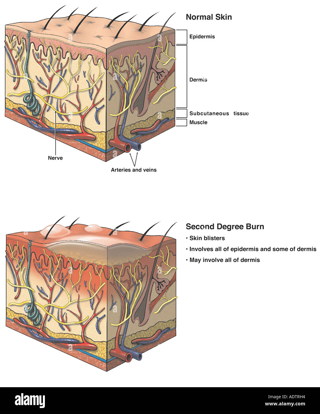 Second degree burn skin hi-res stock photography and images - Alamy
