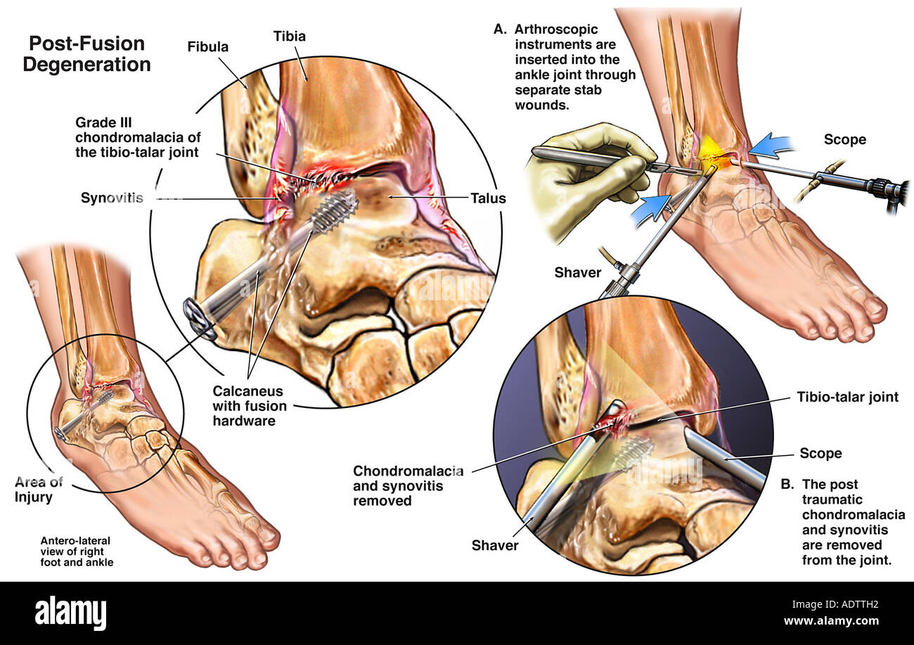 Calcaneal surgery hi-res stock photography and images - Alamy