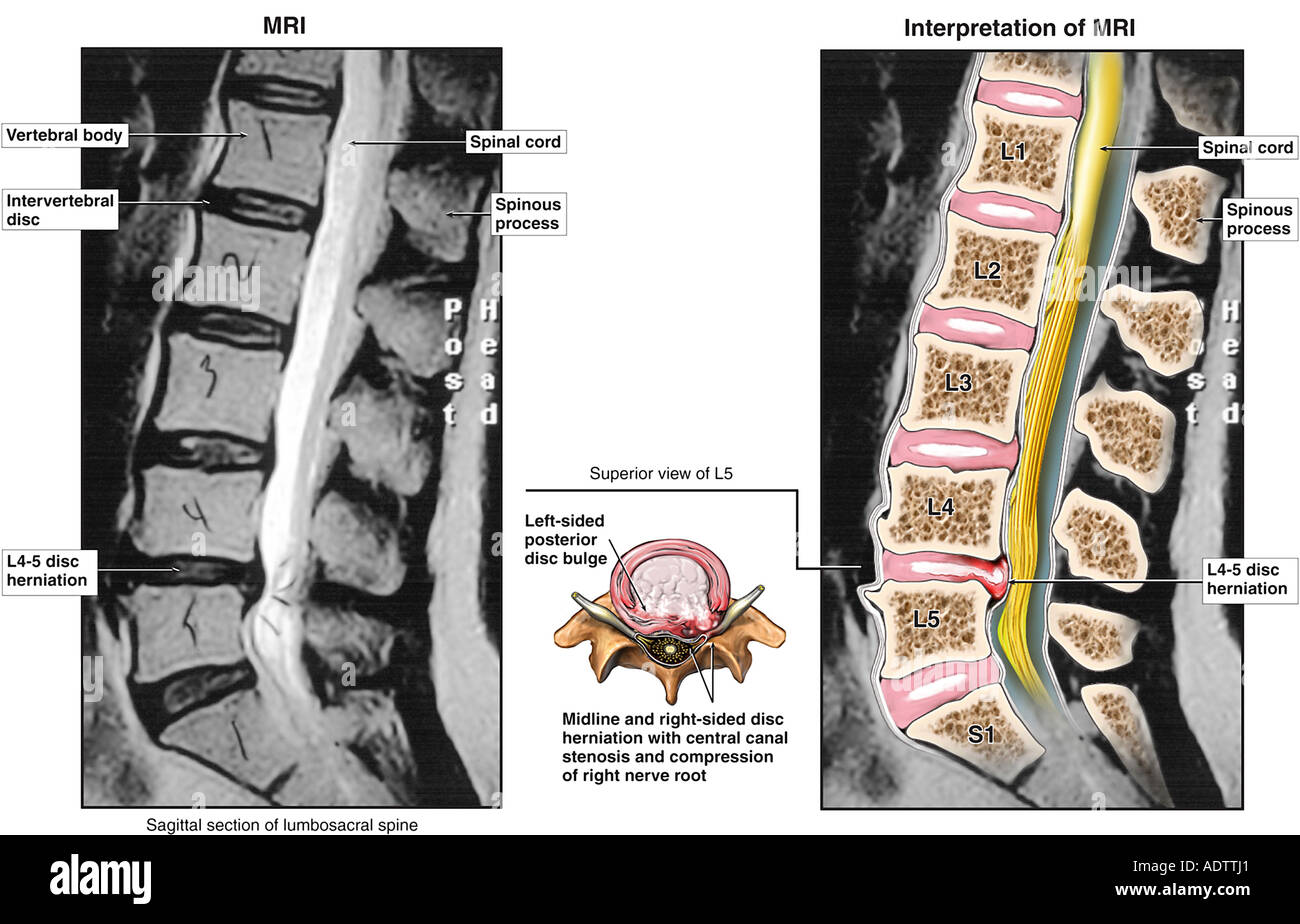 Lumbar spine disc extrusion hi-res stock photography and images - Alamy