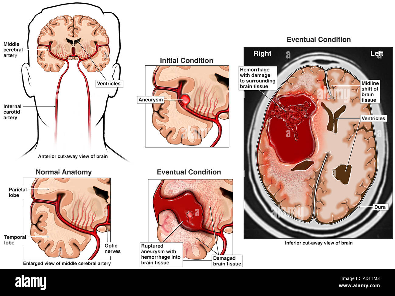 Cerebral Aneurysm