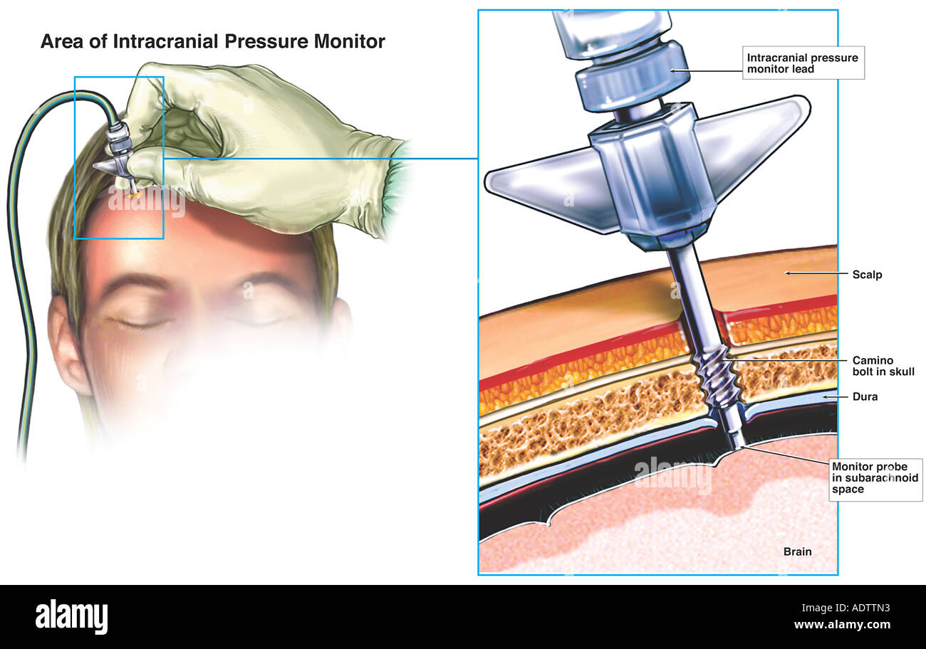 Intracranial Pressure