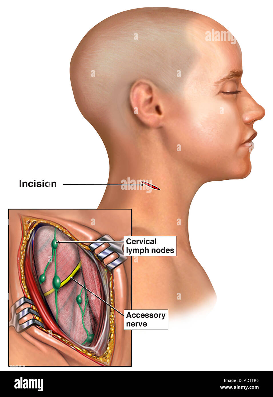 Neck Lymph Node Biopsy