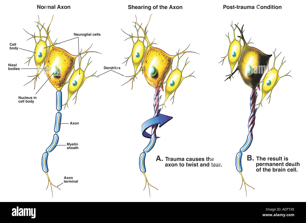 Axon Shear (Post-concussion Syndrome Stock Photo, Royalty Free Image ...
