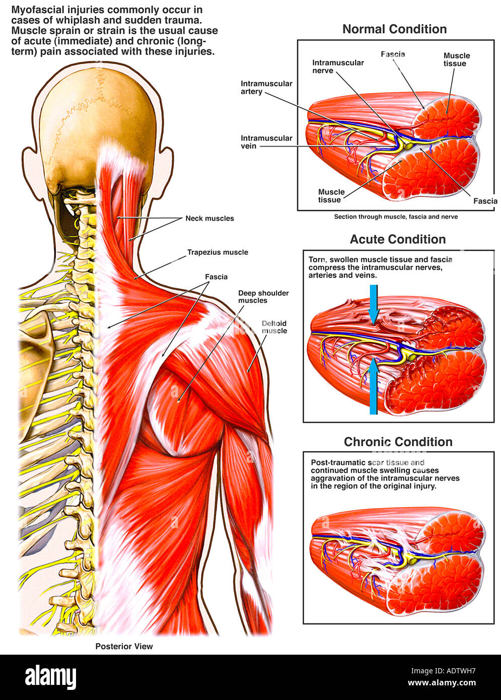 Back Sprain Stock Photos & Back Sprain Stock Images - Alamy