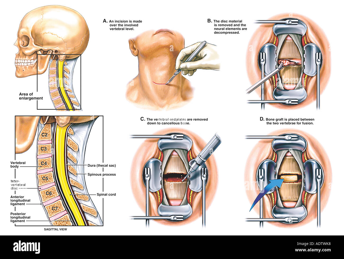 Anterior cervical discectomy hi-res stock photography and images - Alamy
