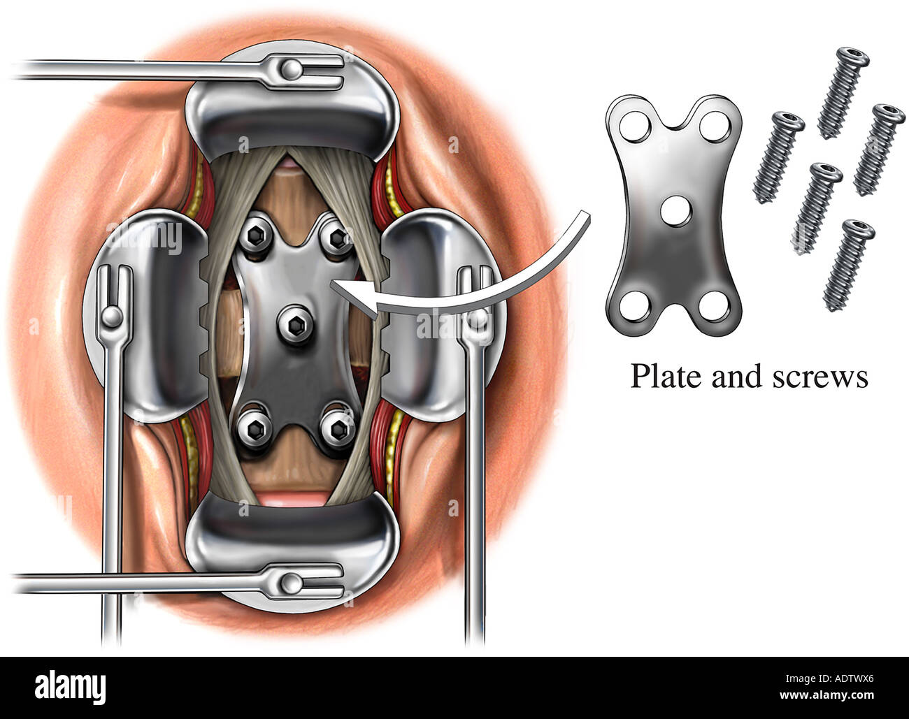 Fusion of the vertebrae hi-res stock photography and images - Alamy