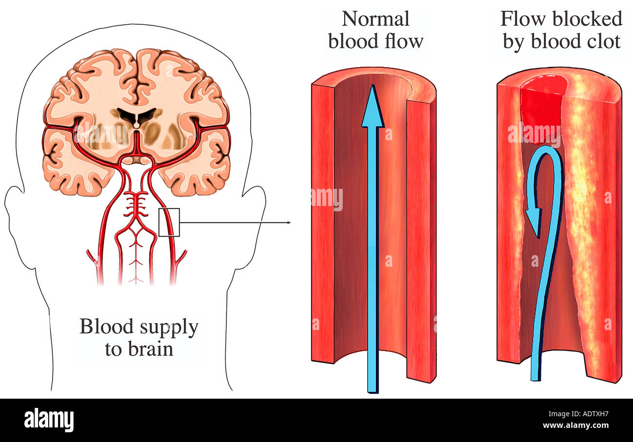 Blood clot hi-res stock photography and images - Alamy