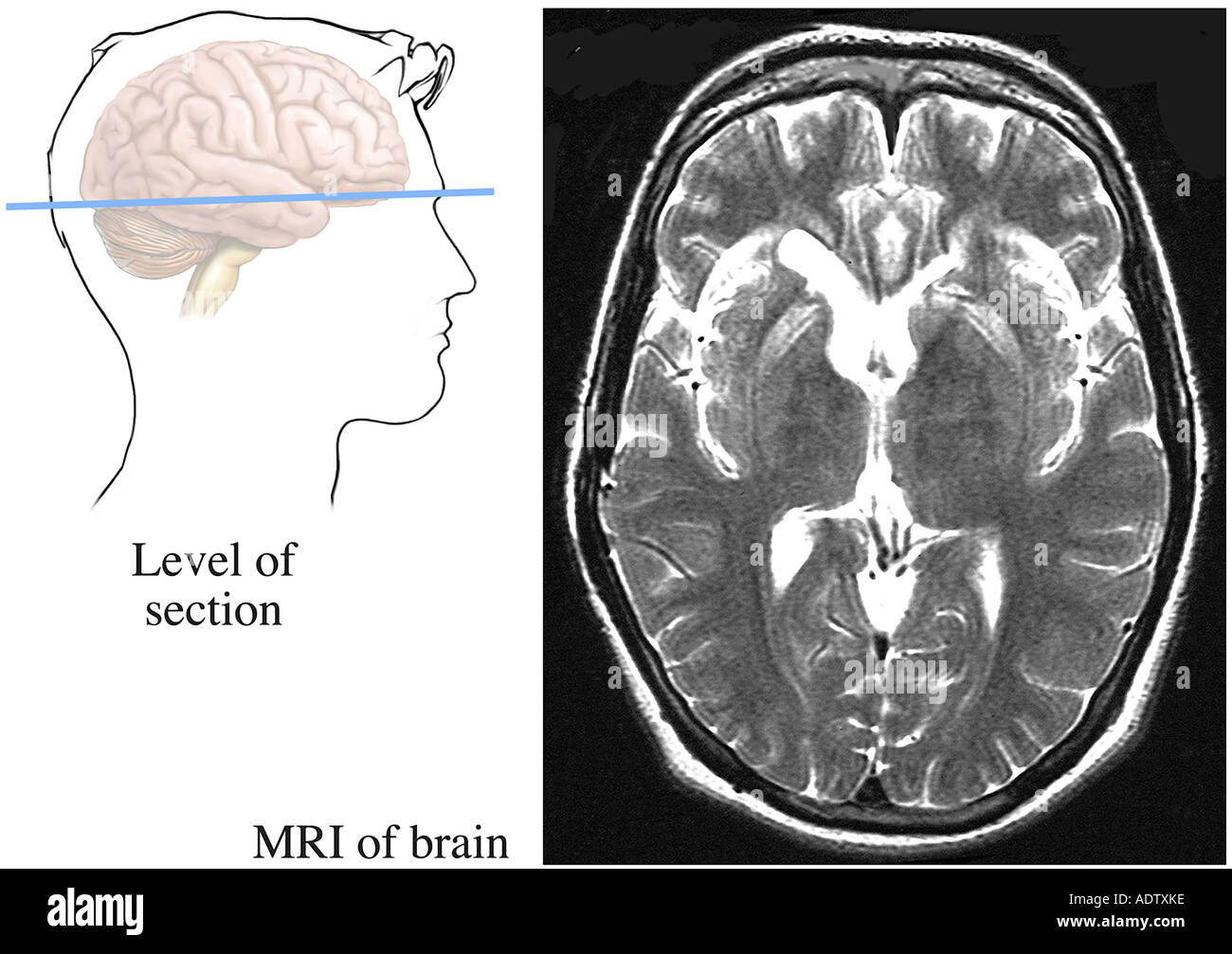 Ventricles of the brain hi-res stock photography and images - Alamy