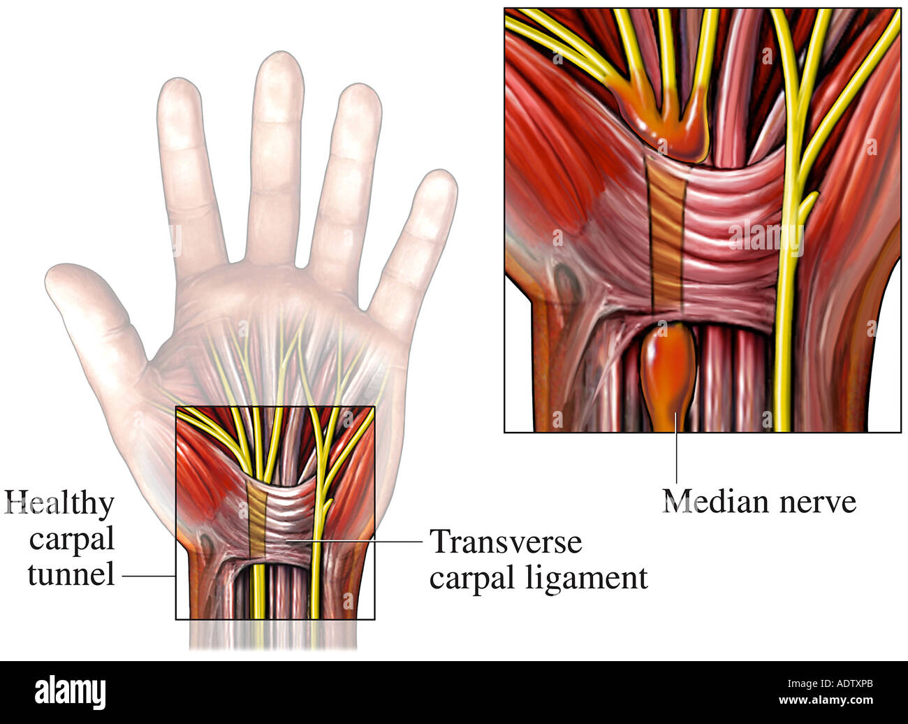 Inflamed nerve hi-res stock photography and images - Alamy
