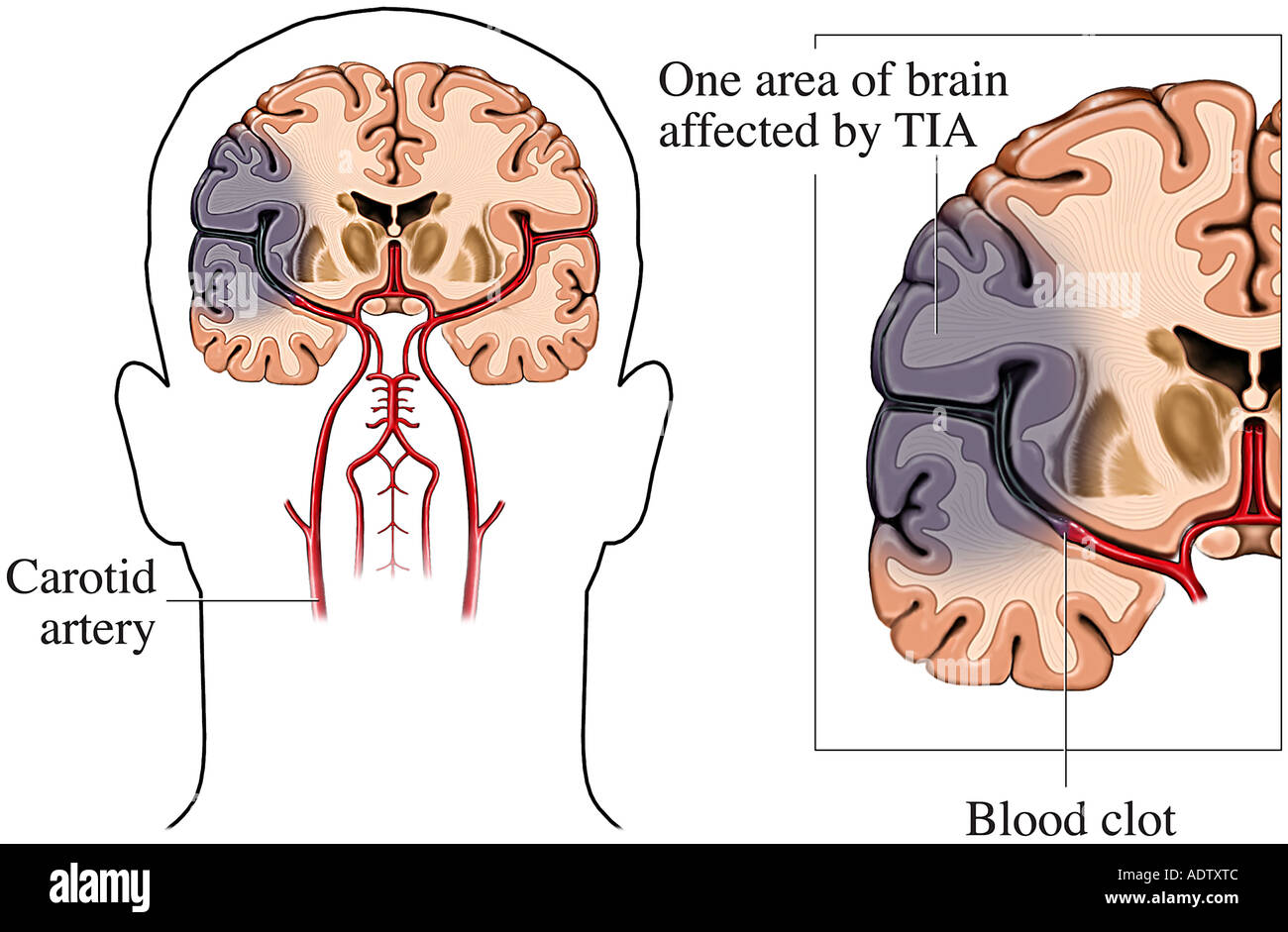Acute cerebral infarction hi-res stock photography and images - Alamy