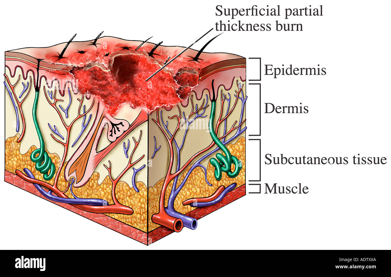 Superficial Partial Thickness Burn Hi Res Stock Photography And Images