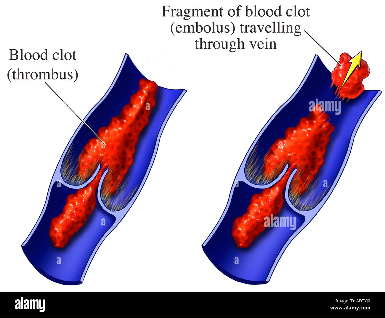 Venous clot hi-res stock photography and images - Alamy