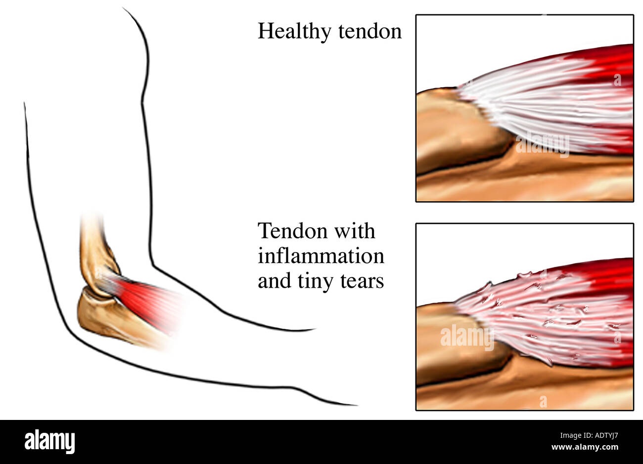 Tennis elbow hi-res stock photography and images - Alamy
