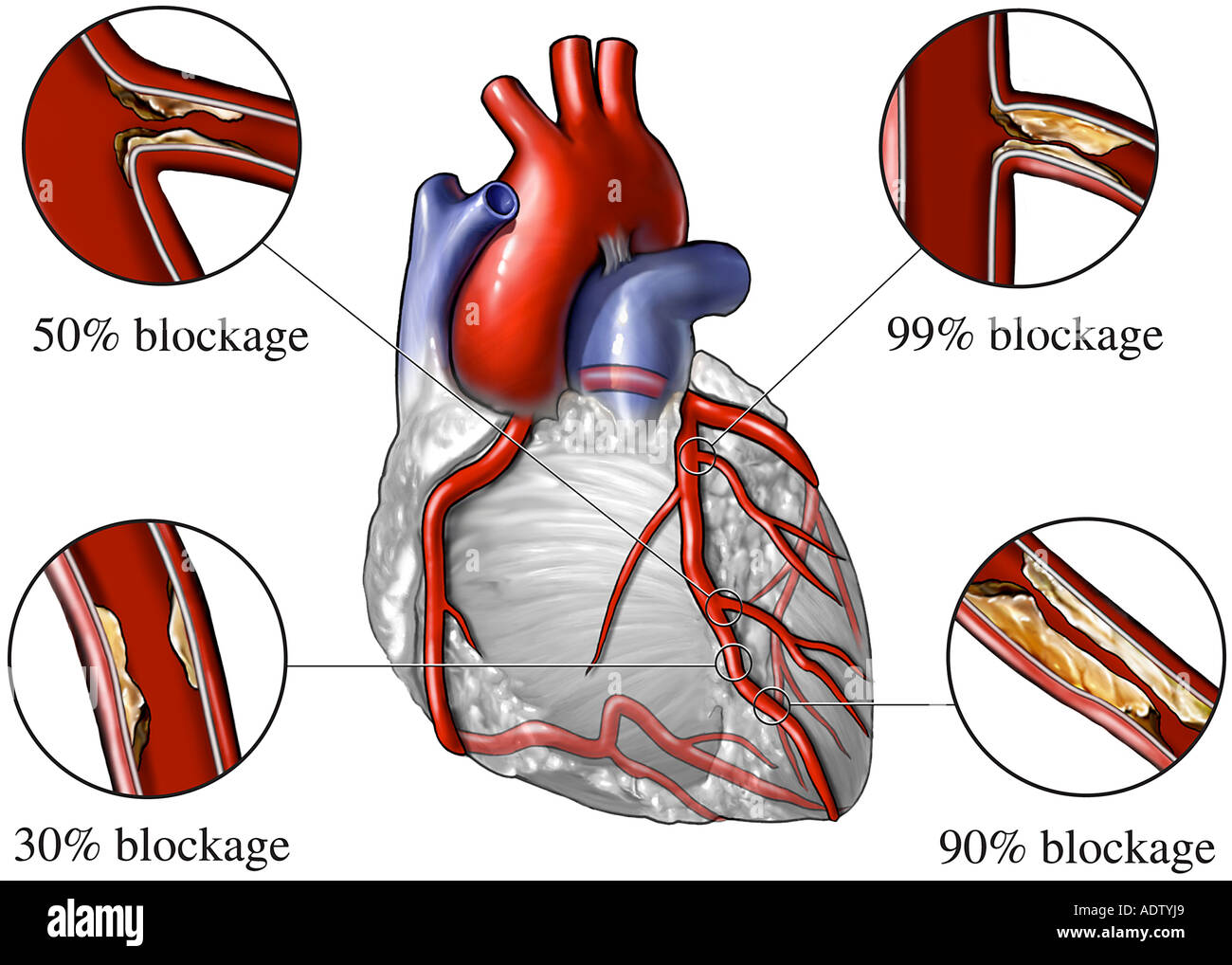 Heart blockage hi-res stock photography and images - Alamy