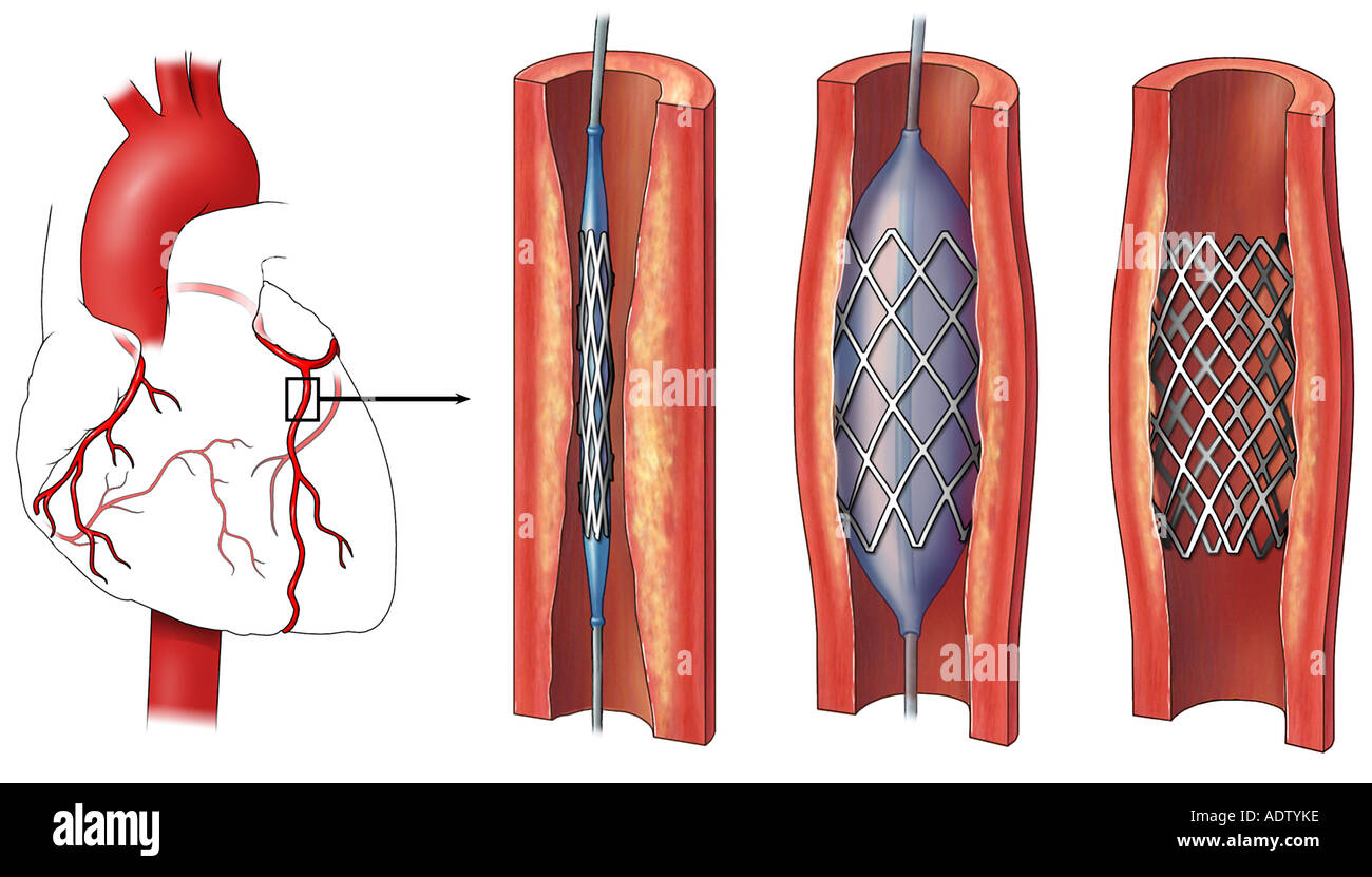 Coronary Artery: Stent Procedure Stock Photo: 7710845 - Alamy Coronary Artery: Stent Procedure Stock Photo: 7710845 - Alamy