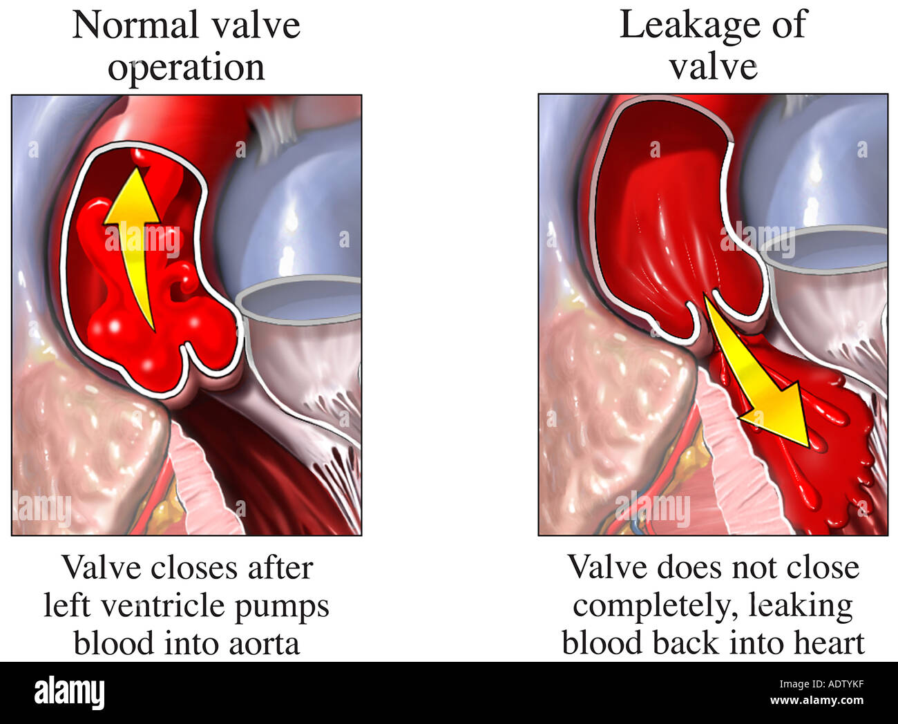 Aortic Stock Photos & Aortic Stock Images - Alamy