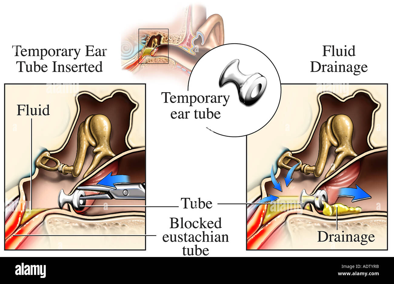 Eustachian Tube