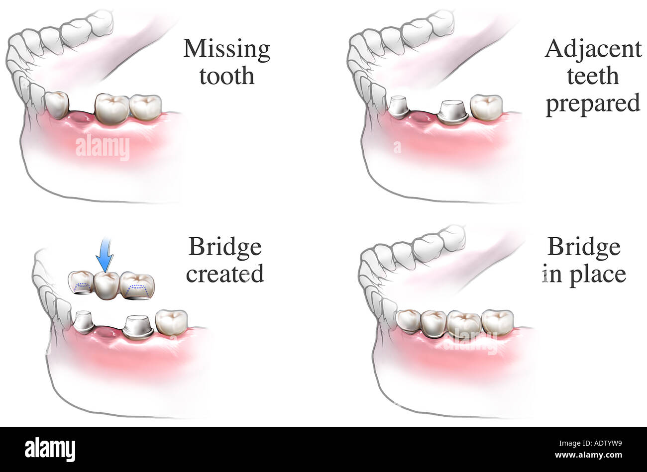 Dental Bridge Procedure