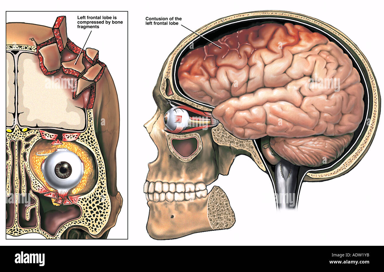 Frontal lobe damage hi-res stock photography and images - Alamy