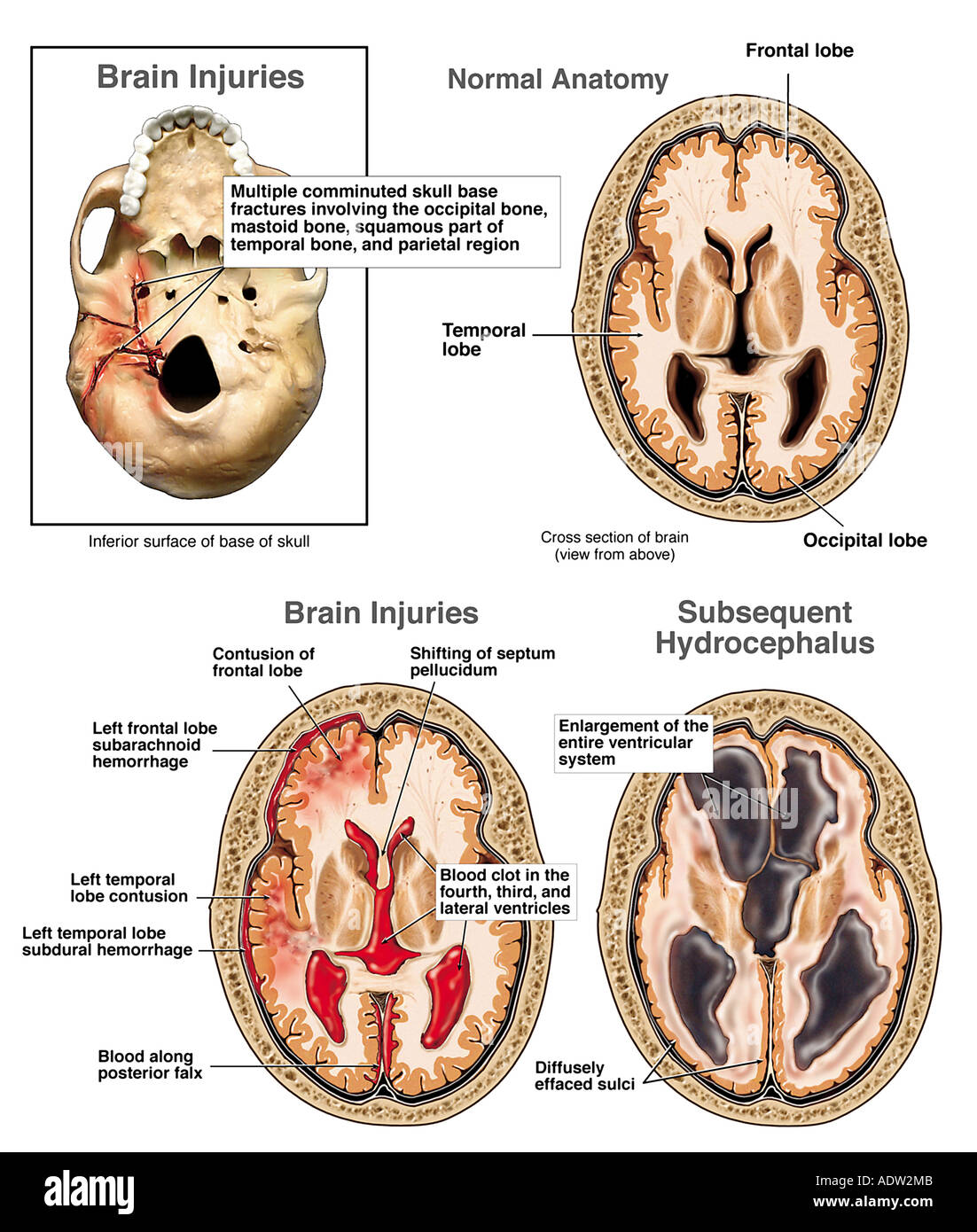 Skull fracture trauma hi-res stock photography and images - Alamy