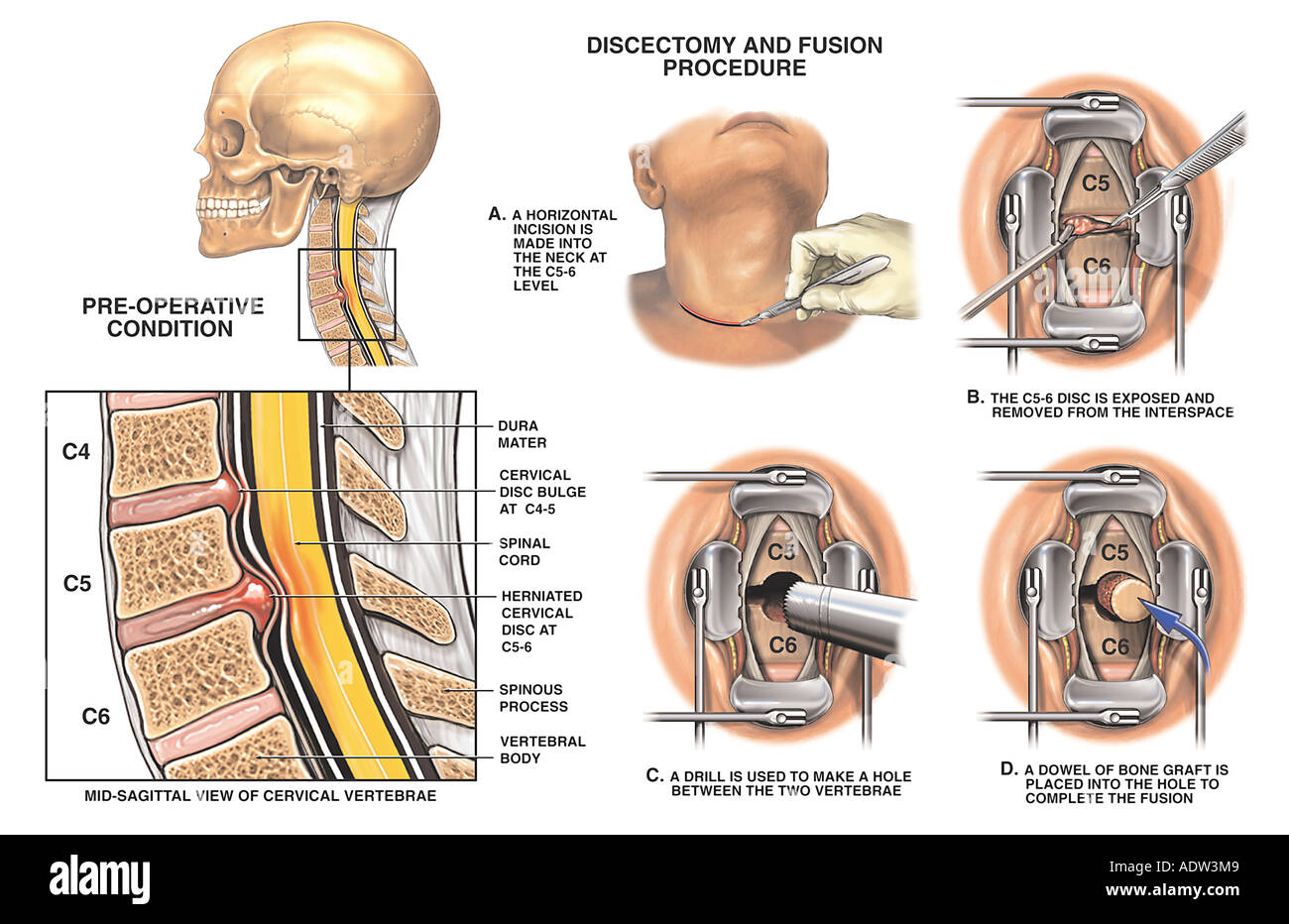 Anterior Cervical Discectomy Hi res Stock Photography And Images Alamy