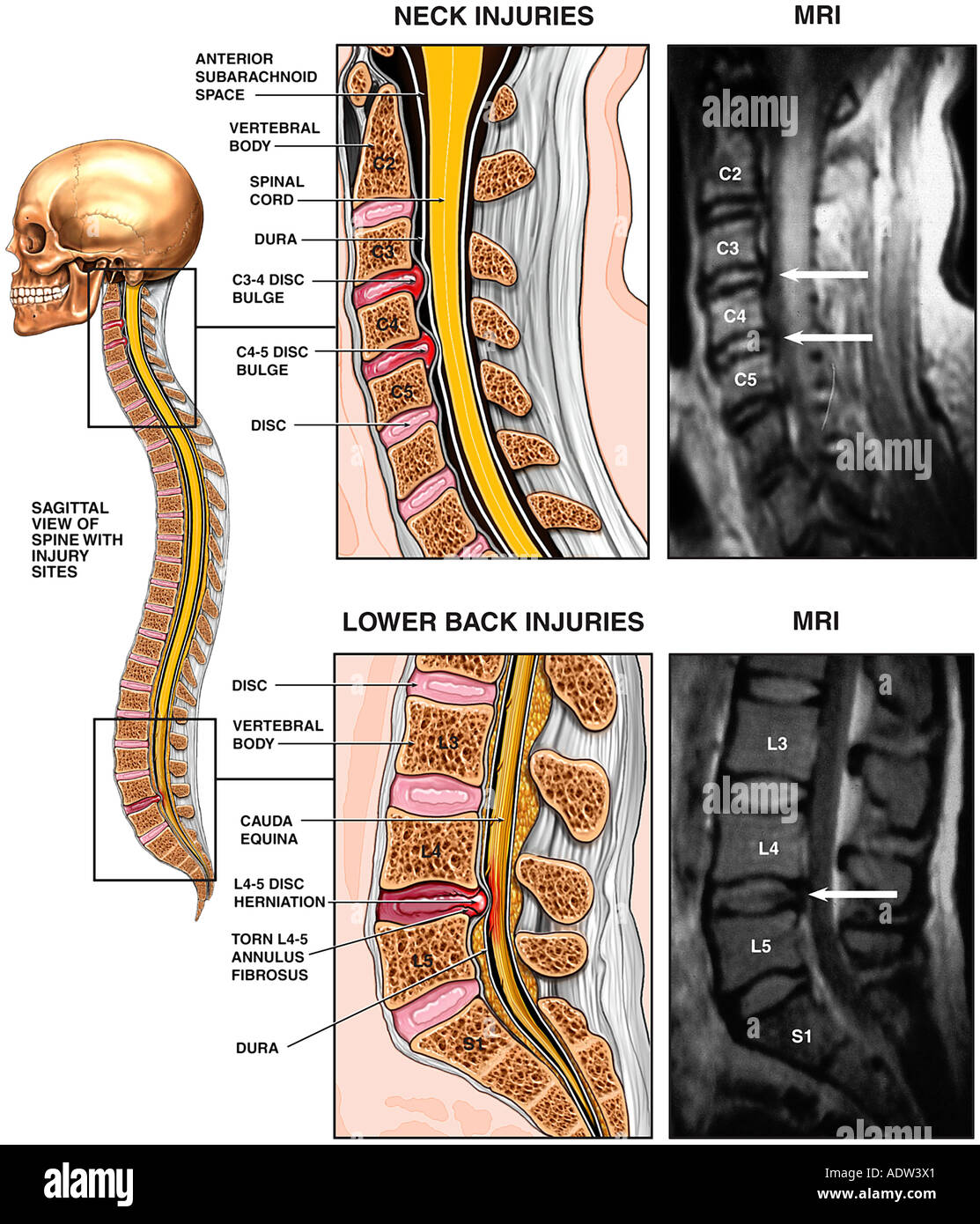 Mri Neck Spine Stock Photos & Mri Neck Spine Stock Images - Alamy