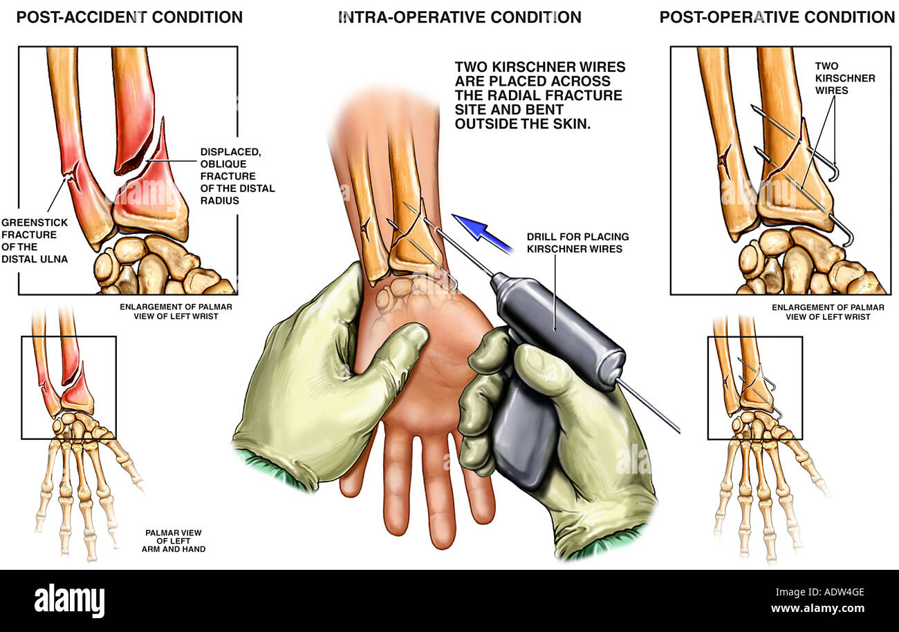 Scaphoid Wrist Fracture High Resolution Stock Photography and Images ...