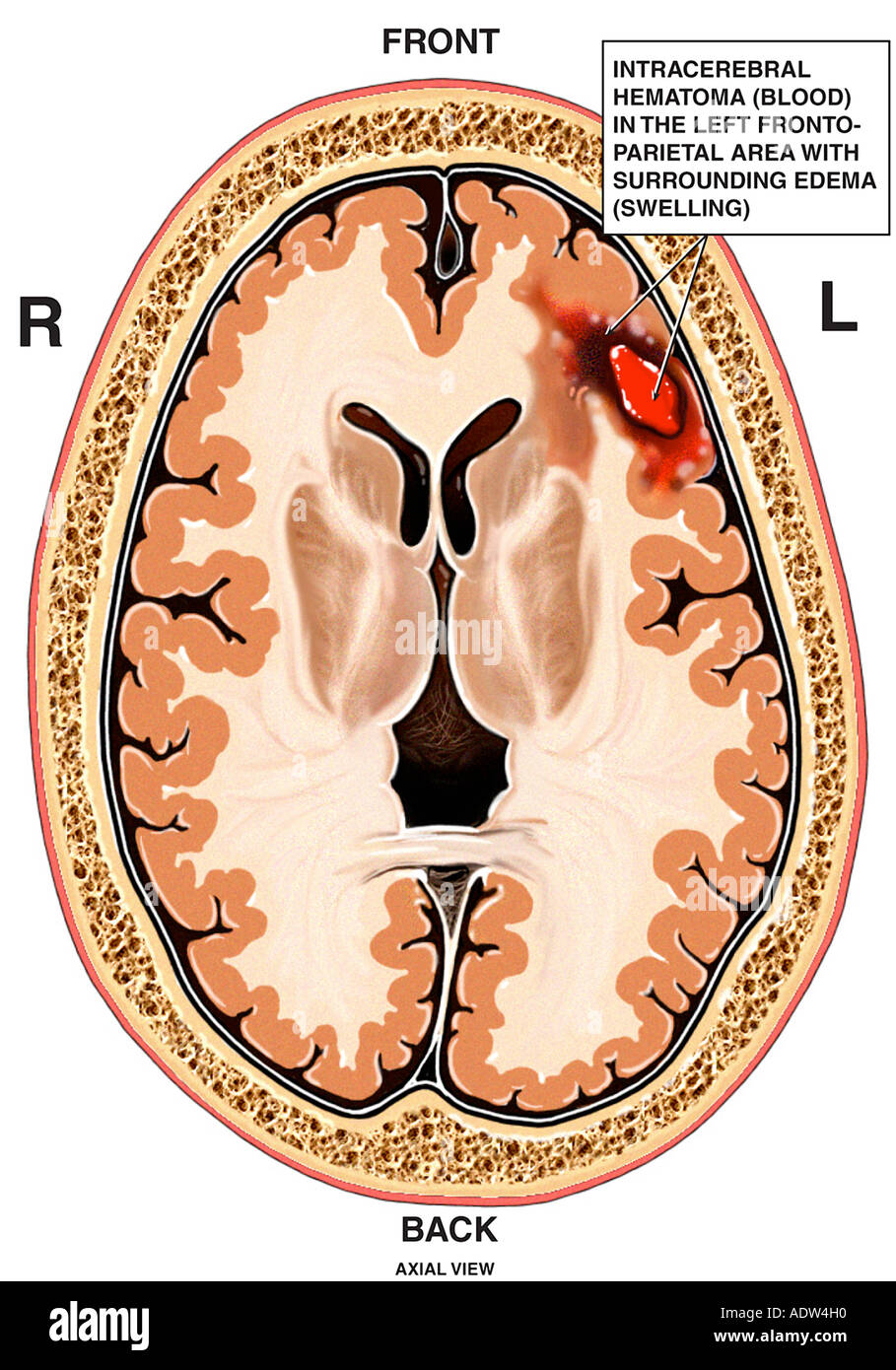 Hemorrhaged hi-res stock photography and images - Alamy