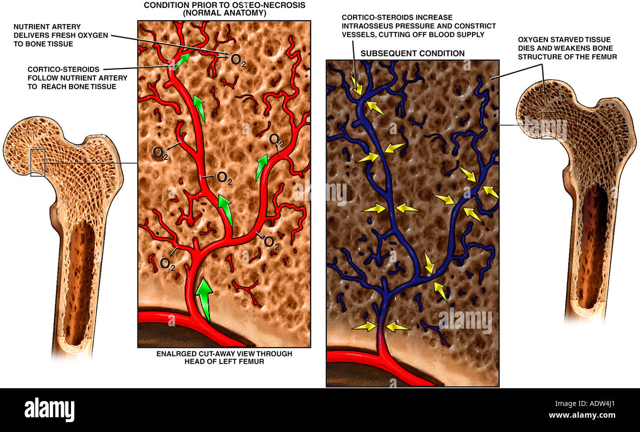 Osteonecrosis hi-res stock photography and images - Alamy