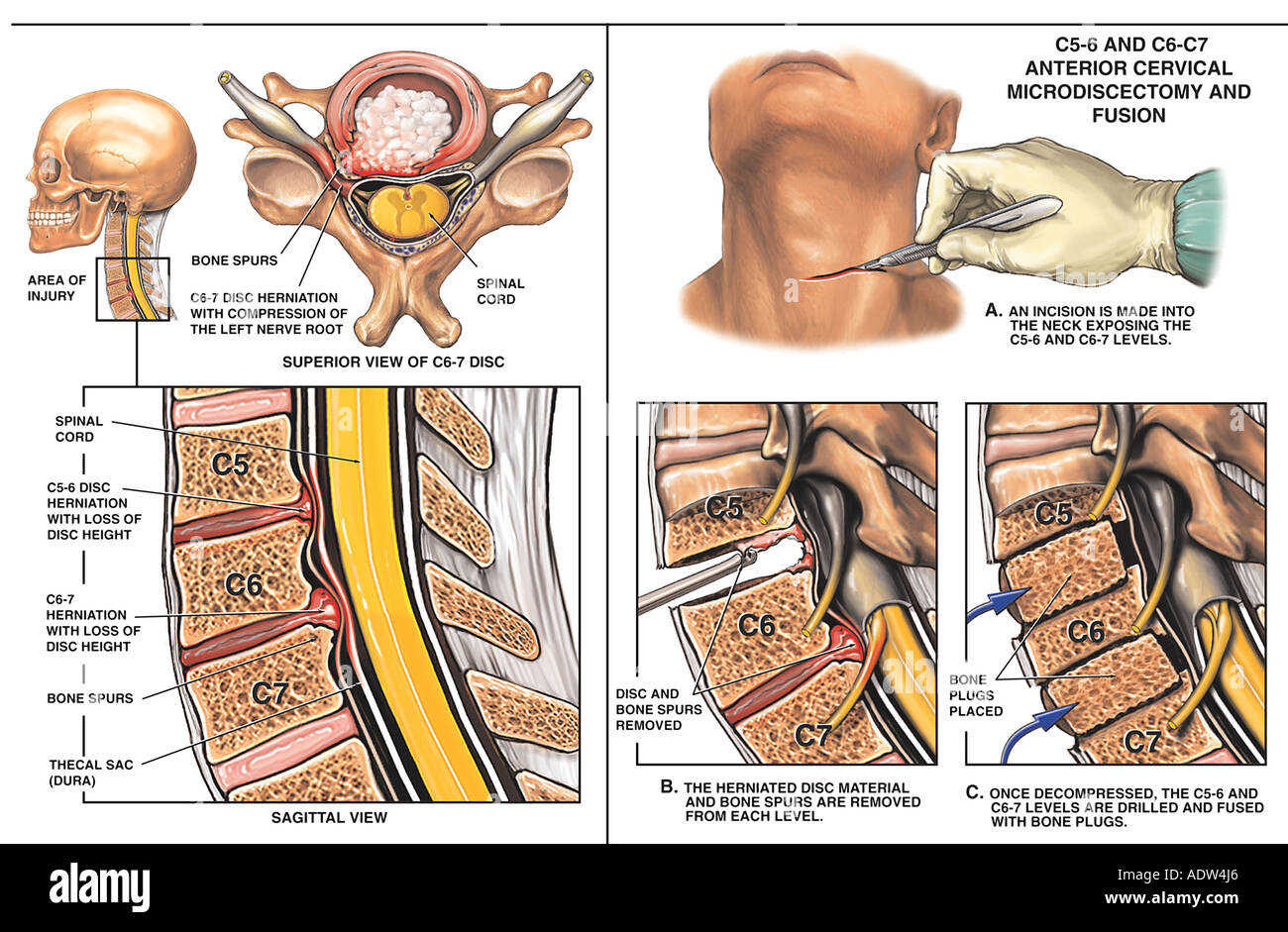 Anterior cervical discectomy hi-res stock photography and images - Alamy