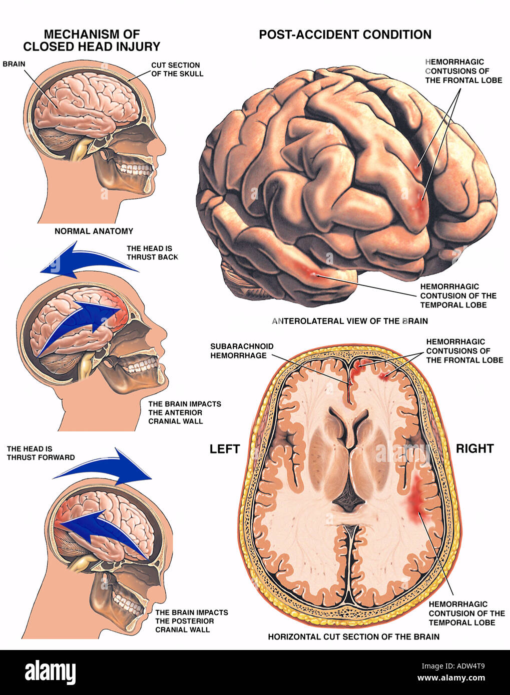 Subdural hematoma hi-res stock photography and images - Alamy