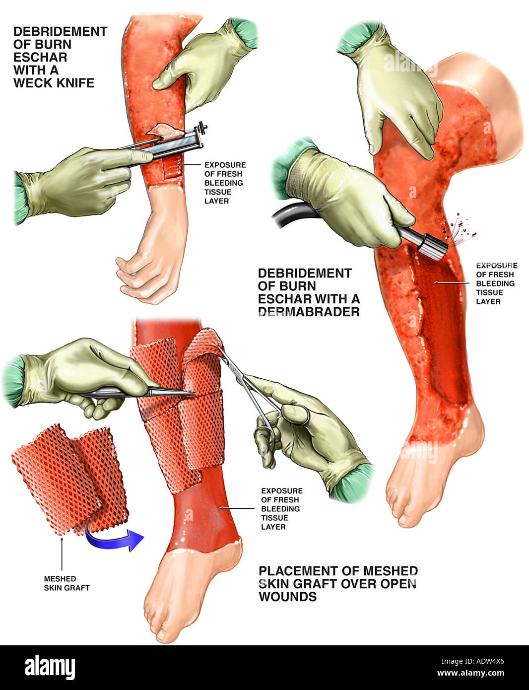 Surgical Debridement of Burns with Skin Grafting Procedure Stock Photo ... Surgical Debridement of Burns with Skin Grafting Procedure Stock Photo ...