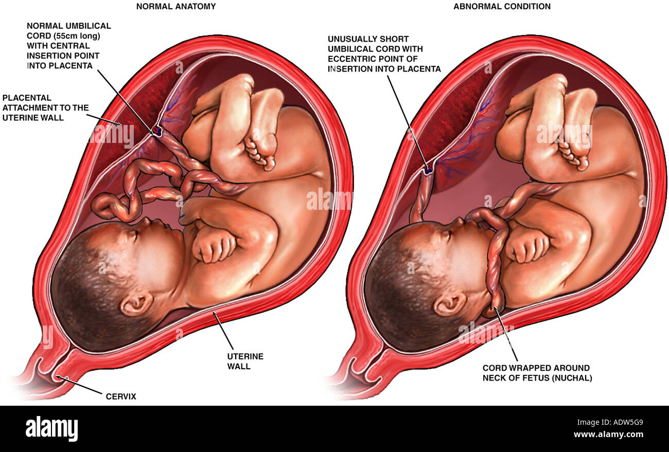 Abnormal Umbilical Cord Nuchal Cord Stock Photo Alamy Abnormal Umbilical Cord Nuchal Cord Stock Photo Alamy