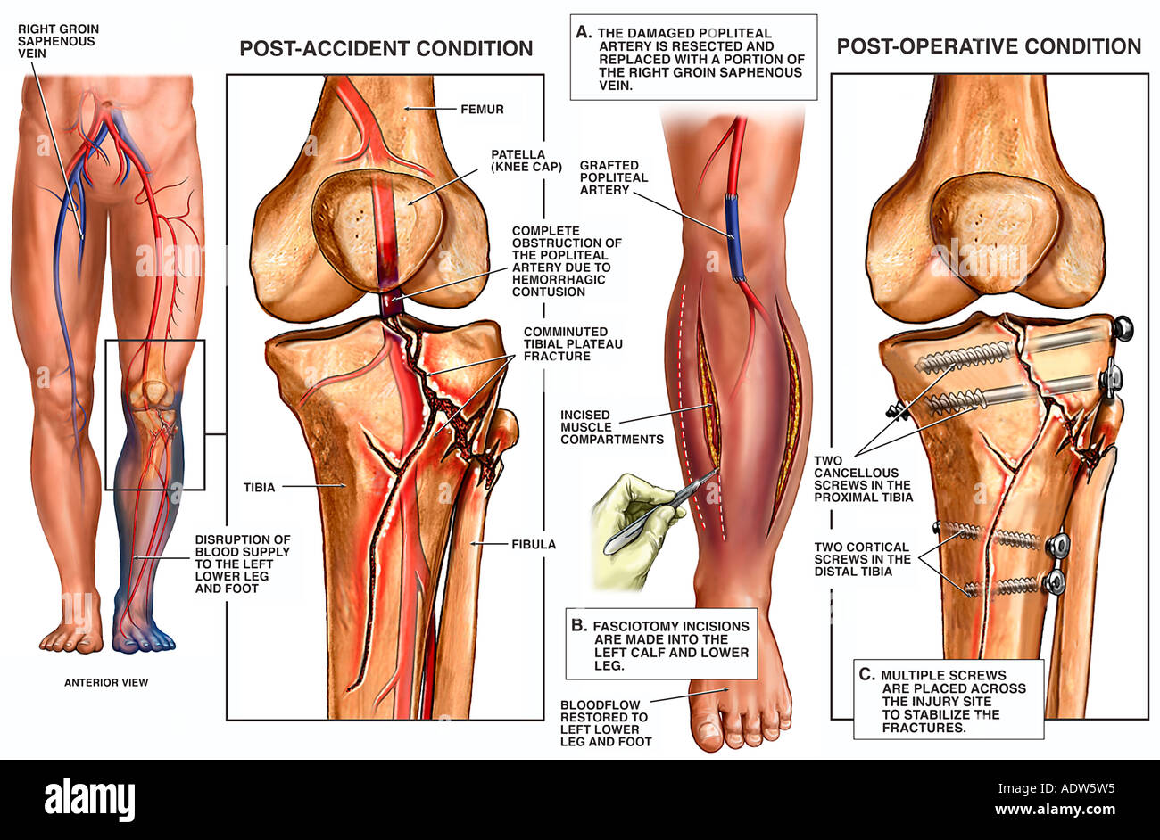 Knee Injury Tibial Plateau Fractures With Fixation Surgery Stock Photo Knee Injury Tibial Plateau Fractures With Fixation Surgery Stock Photo