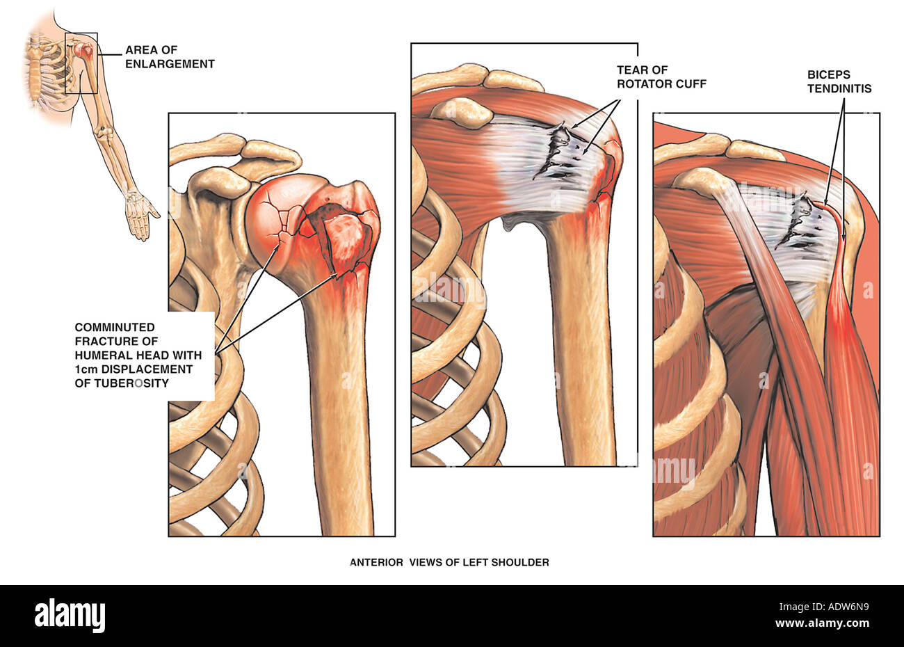 Torn Ligament In Shoulder Cheaper Than Retail Price Buy Clothing