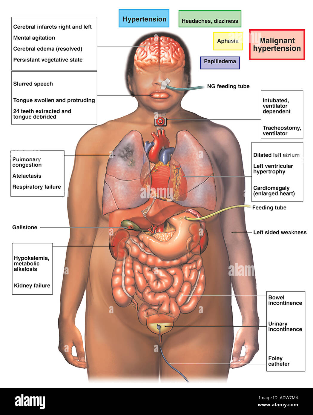 Papilledema High Resolution Stock Photography and Images - Alamy