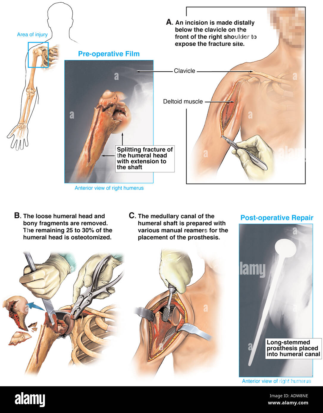 Total Shoulder Joint Replacement Surgery Arthroplasty Stock Photo