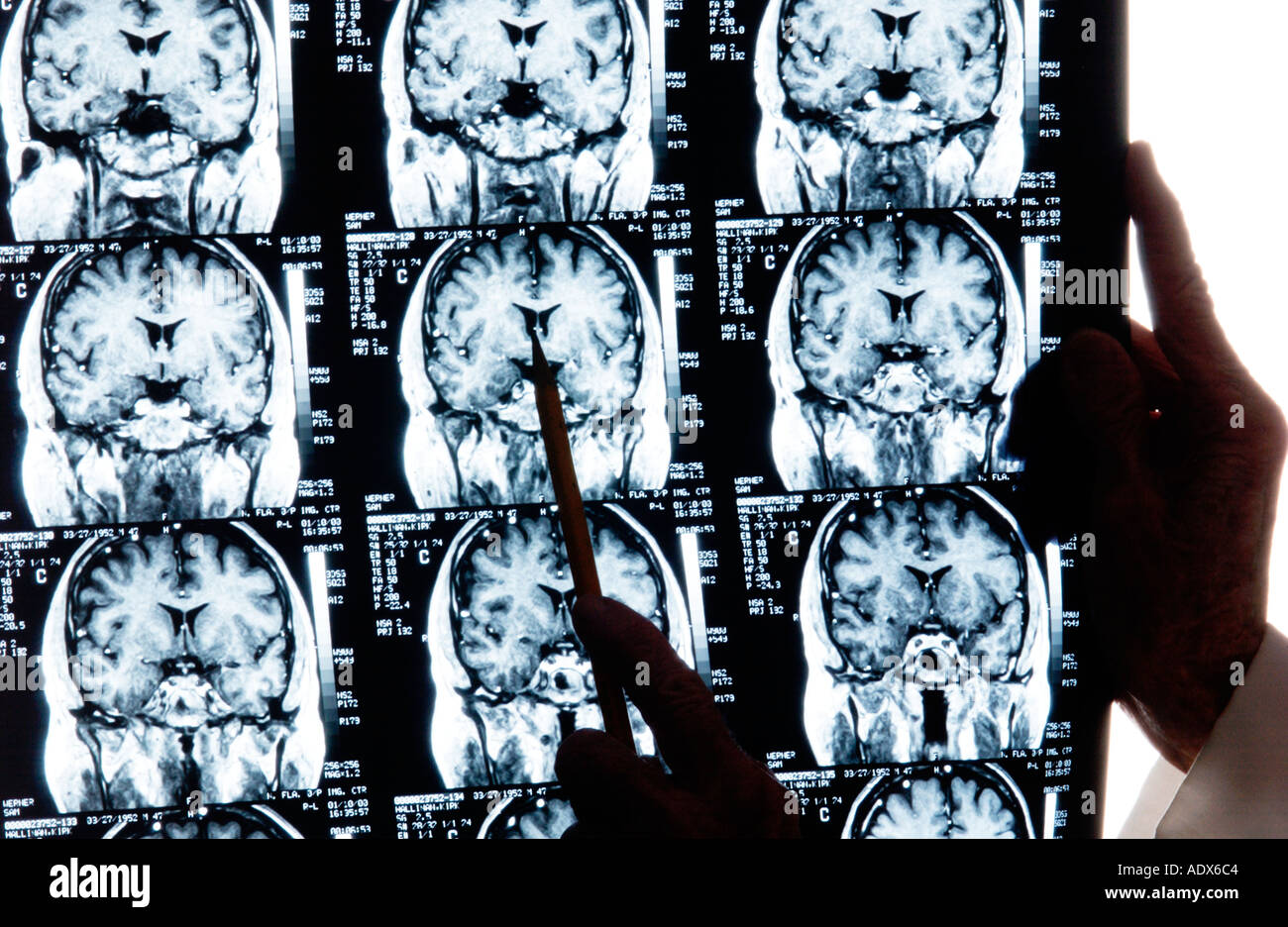 medical technician examining x-rays of cerebral cortex cerebellum human ...