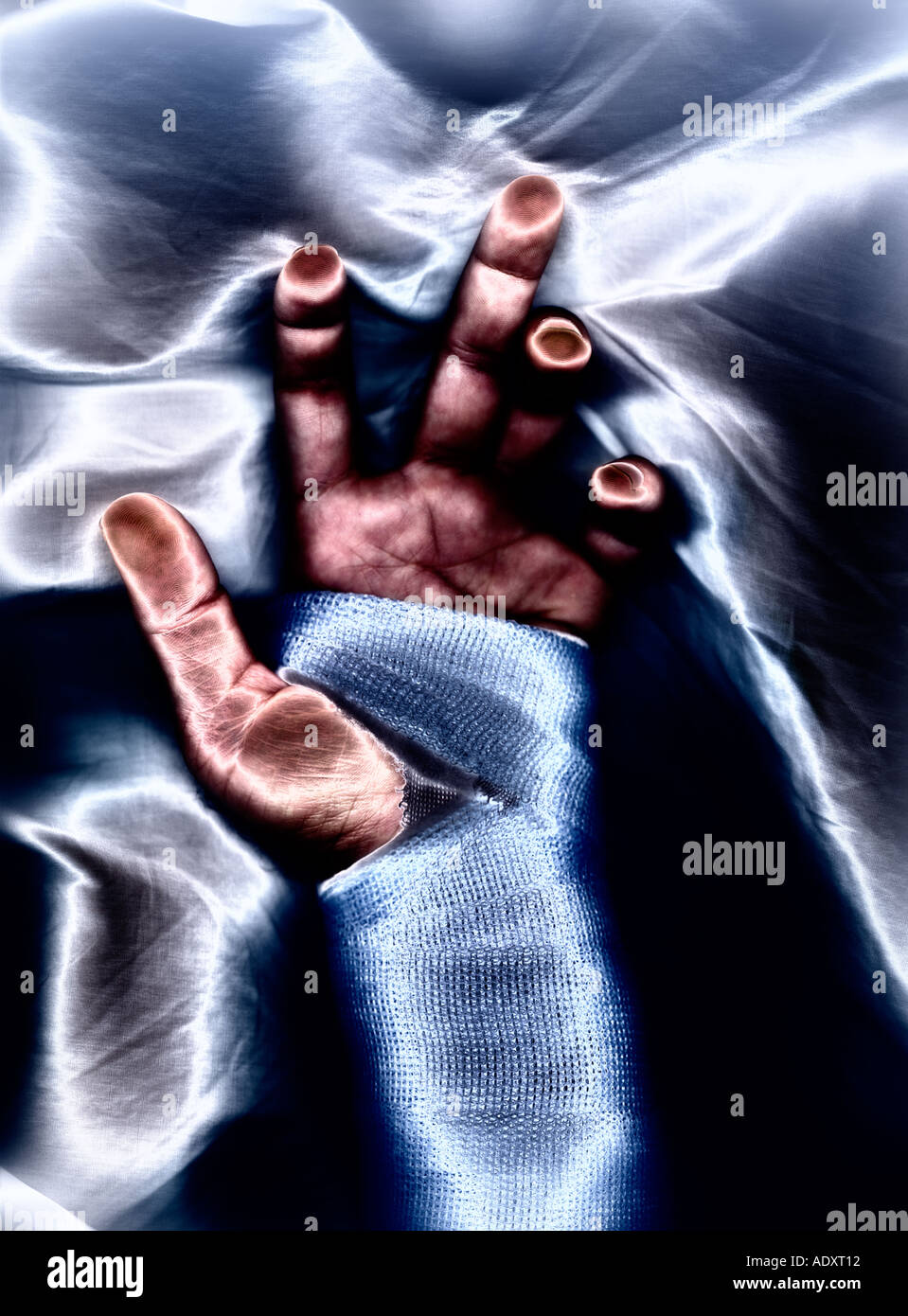 Fiberglass cast wrist hi-res stock photography and images - Alamy