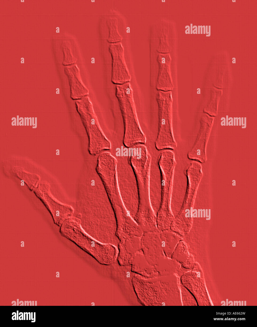 Enhanced conventional film based radiograph or xray of a human hand ...