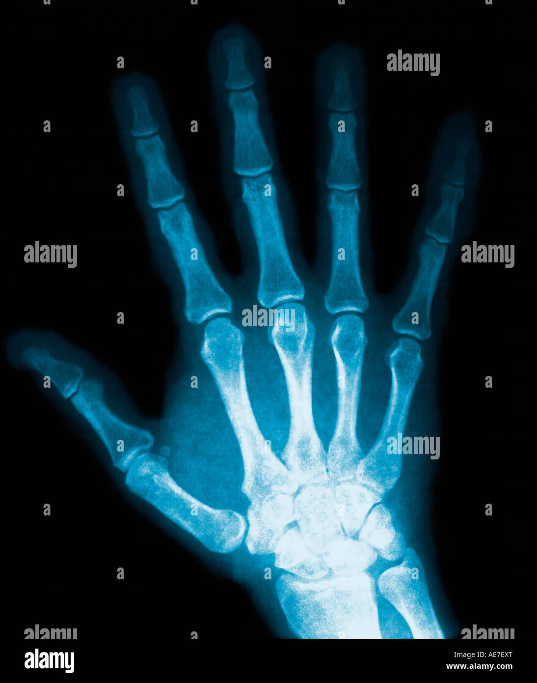 Color-enhanced conventional film based radiograph or xray of a human ...